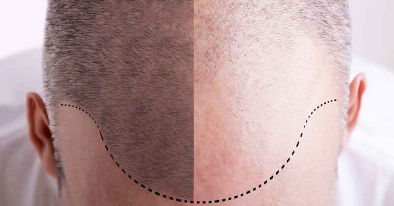 Importance of Hairline Design | Austin Hair Restoration Clinic