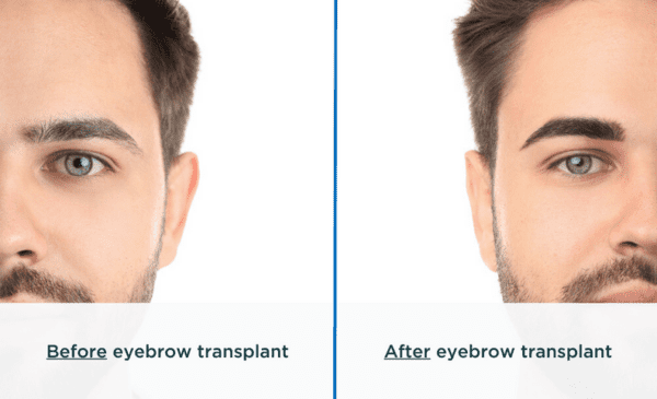 Eyebrow Hair Transplant in Austin, TX | Austin Hair Restoration Clinic