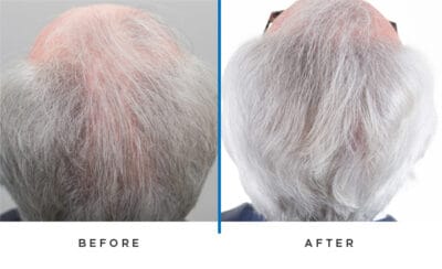 Capillus Low-Level Laser Therapy Clinic in Austin, TX